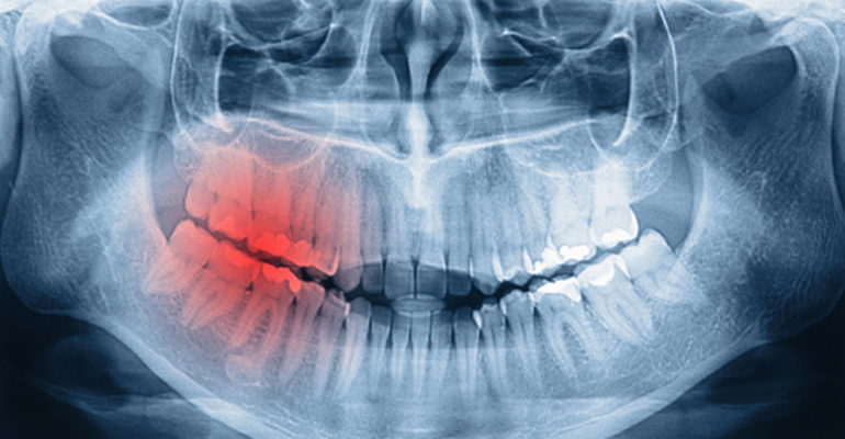 Cavitations - Holistic Biological Dentistry | Dr. Jesús Carlos Ornelas