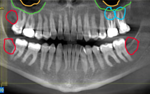 Cavitations - Holistic Biological Dentistry | Dr. Jesús Carlos Ornelas