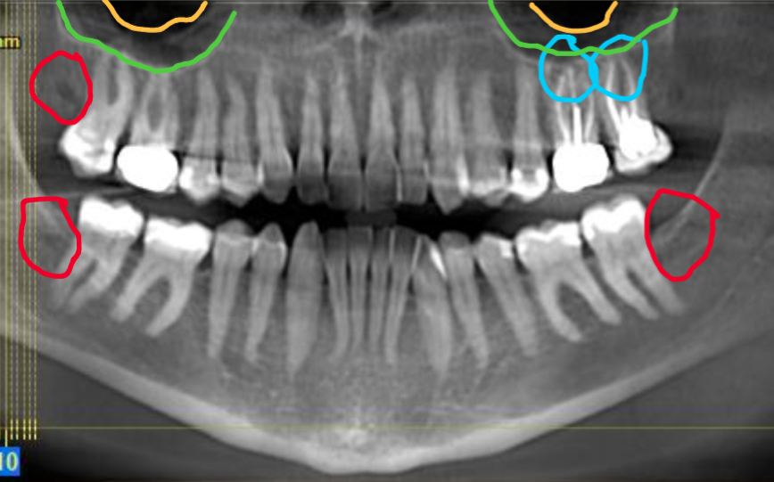 Cavitations - Holistic Biological Dentistry | Dr. Jesús Carlos Ornelas